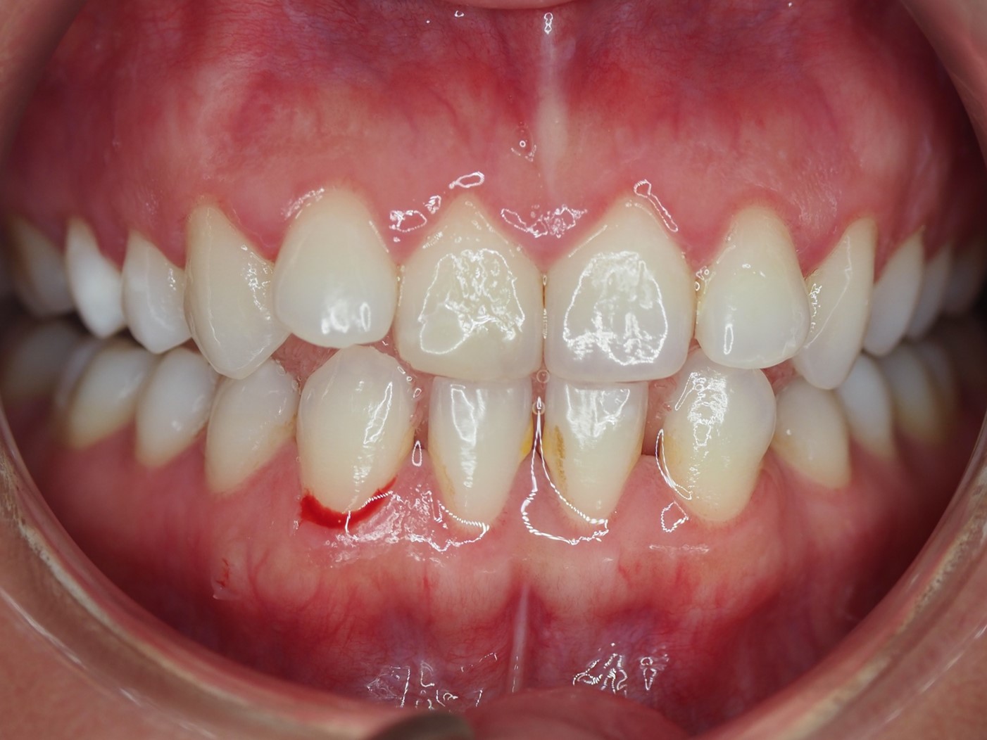 Before & After Pictures - THE FAVOUR DENTAL